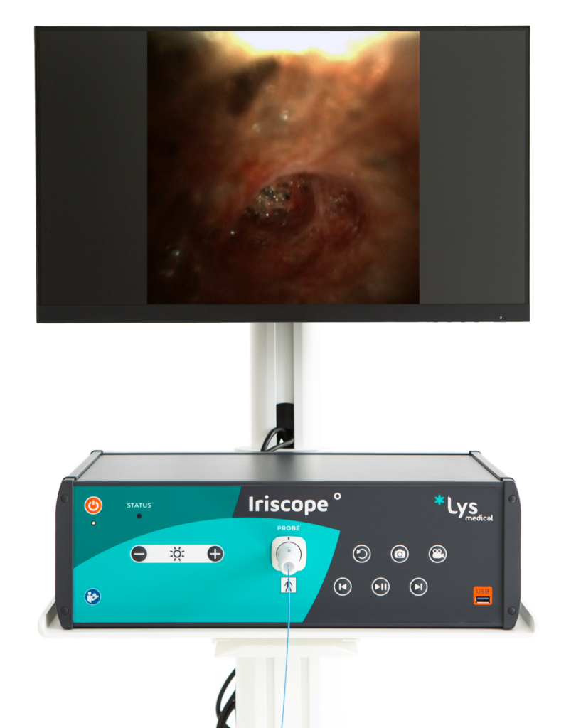 Lys Medical | Iriscope